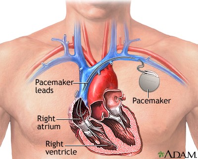 Heart Pacemaker: purpose, types, and responsibilities. – Wlad Haiget ...
